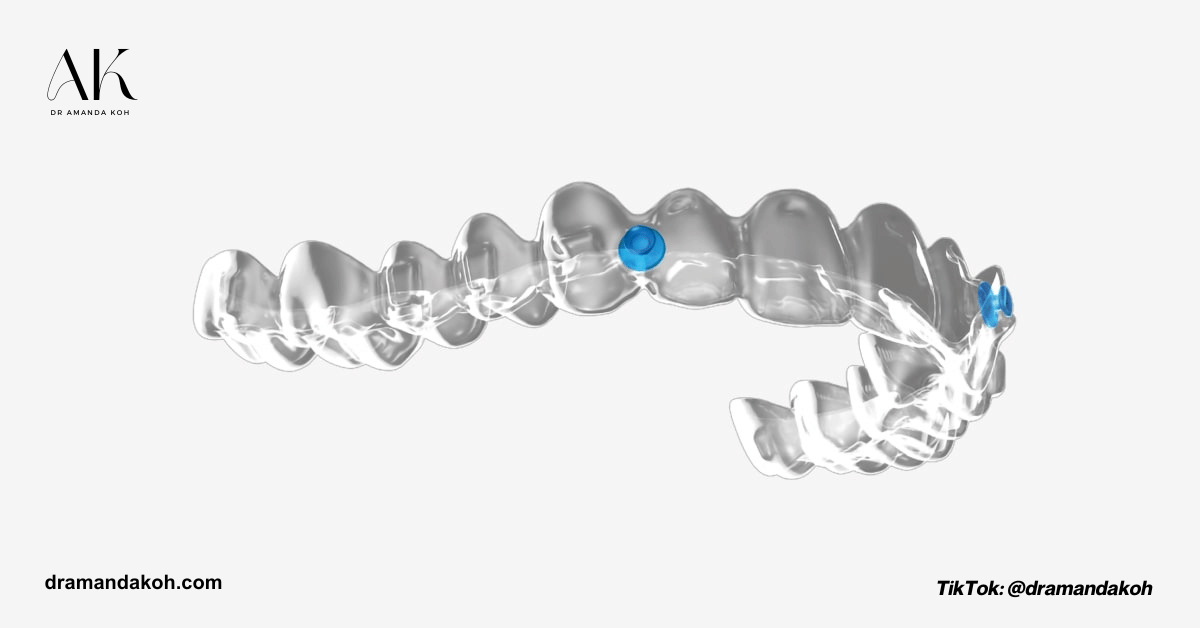 Why Angel Aligners are a Good Invisalign Alternative | Dr Amanda Koh